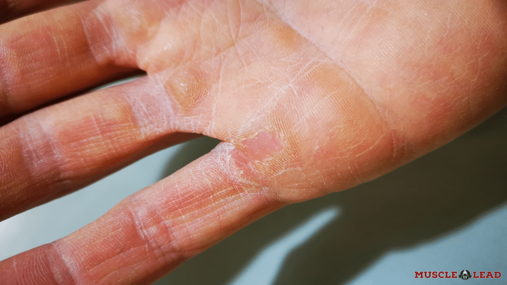 10 Common Deadlift Injuries (+ How To Avoid Them)